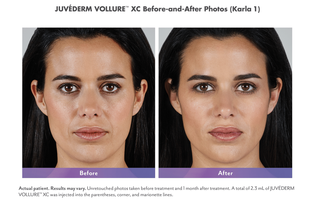 Juvéderm VOLLURE - Refine Aesthetics